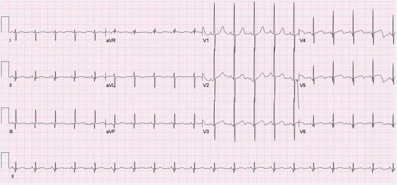 2-Newborn ECG | Basics of Pediatric Anesthesia/Pediatric Anesthesia ...
