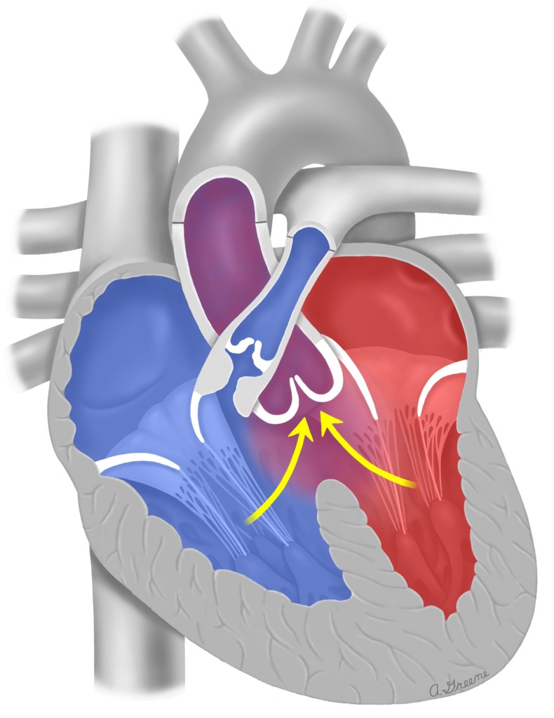 Anatomy_of_tetralogy_of_Fal | Basics of Pediatric Anesthesia/Pediatric ...