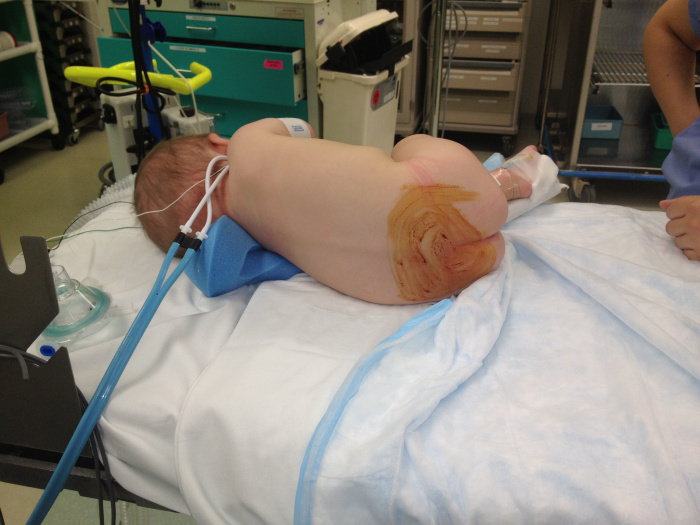 Basics of Pediatric Anesthesia/Pediatric Anesthesia Article of the Day